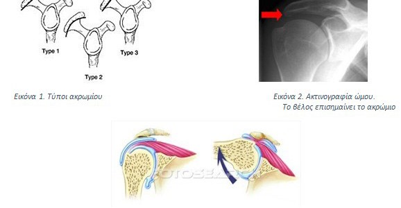 Ωμος Archives - Ορθοπαιδικός στην Αργυρούπολη - Κωνσταντίνος Αναγνώστου