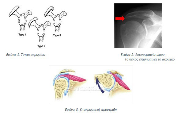 Σύνδρομο υπακρωμιακής προστριβής - Ορθοπαιδικός στην Αργυρούπολη ...